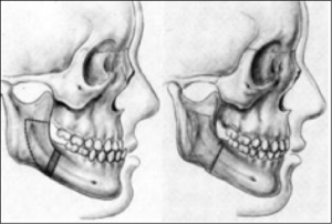 Le traitement chirurgical - orthodontiepourtous.com